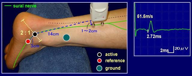 Fisioterapia y electromiografía en patología neuromuscular - ⚕️ Clínica ...