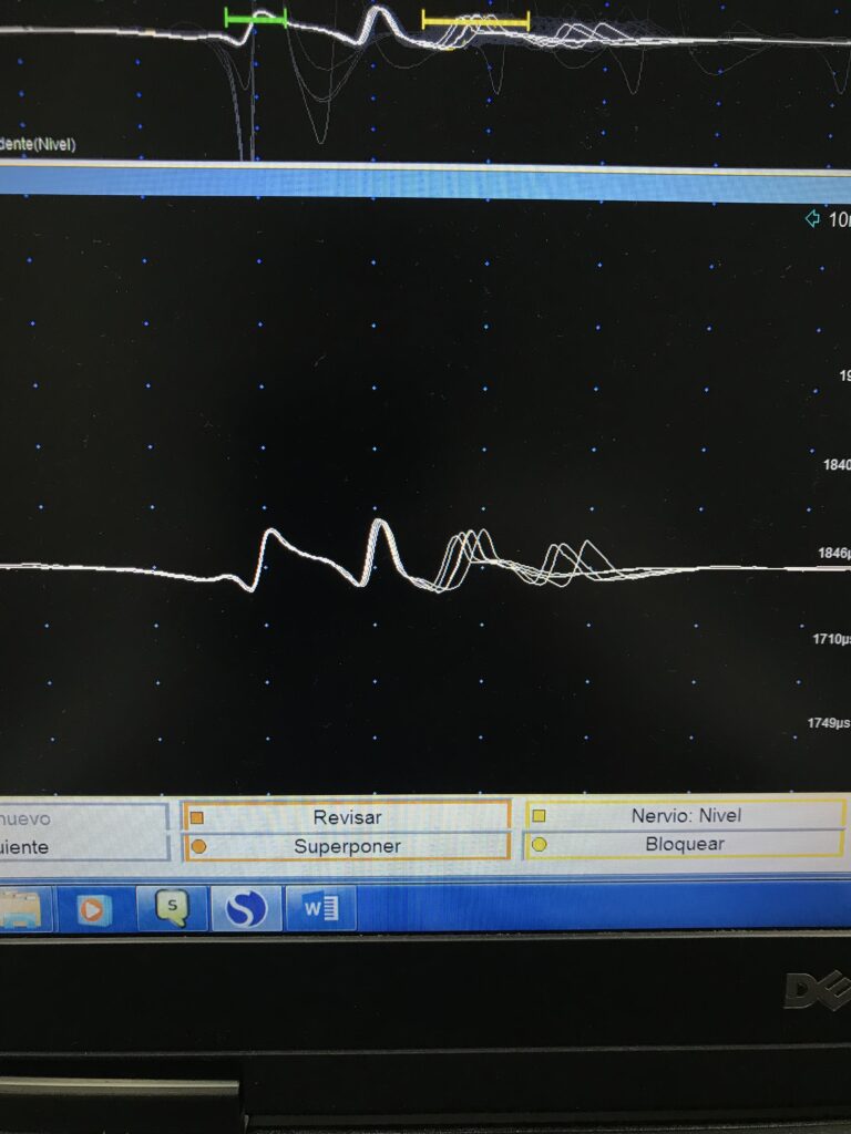 Fisioterapia y electromiografía en patología neuromuscular - ⚕️ Clínica ...