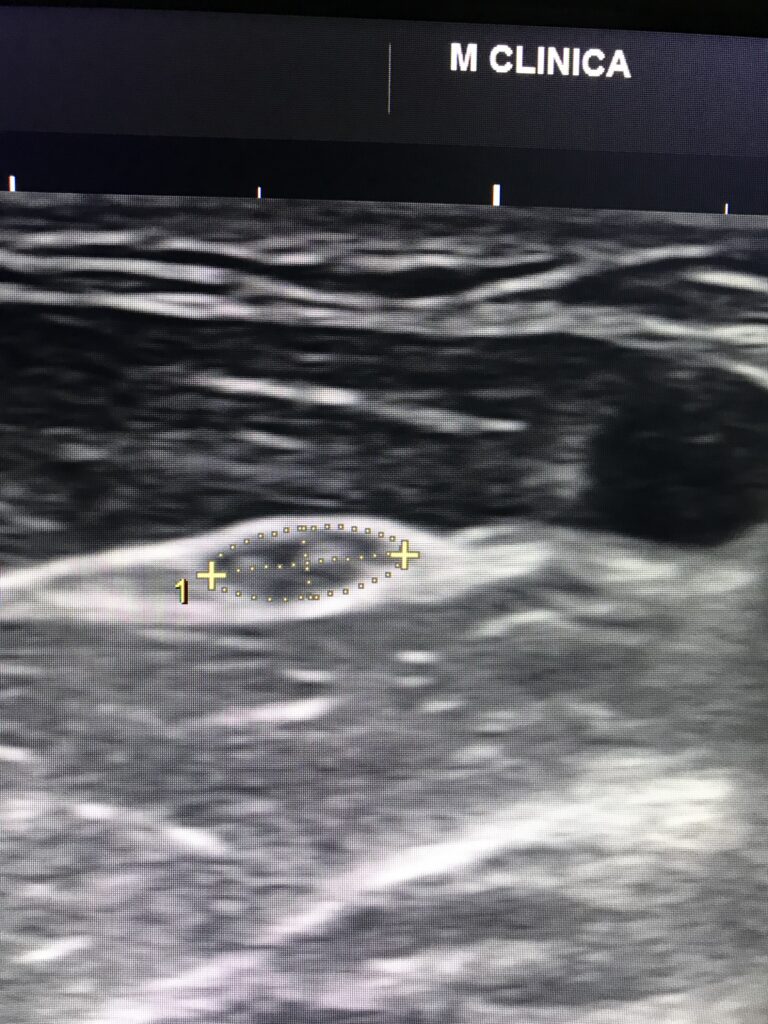 Fisioterapia y electromiografía en patología neuromuscular - ⚕️ Clínica ...